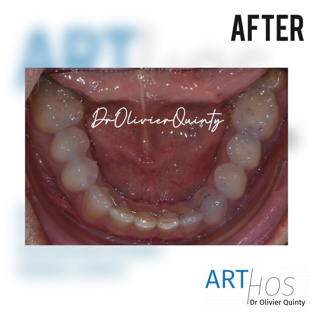 La contention en orthodontie | Dr Olivier Quinty | Cabinet d ...