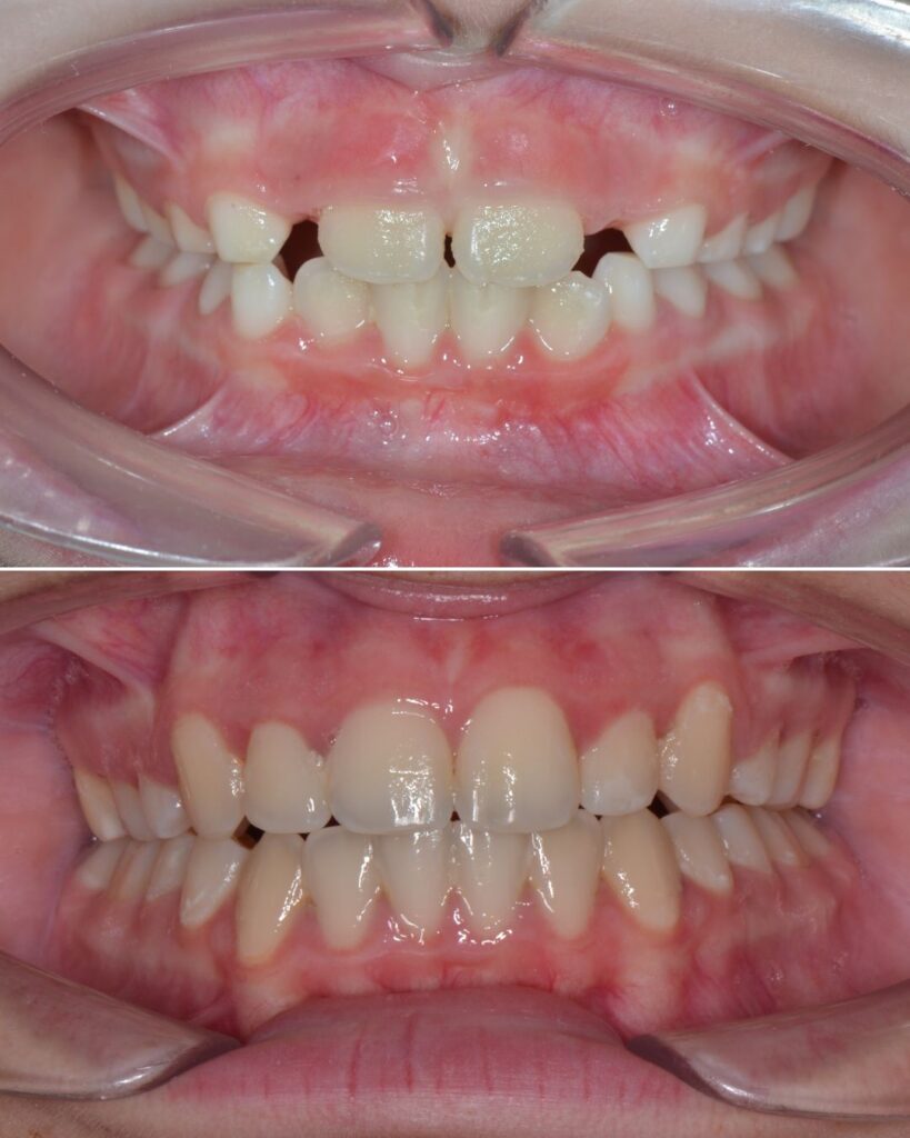 Canines Incluses : Une Explication Complète et les Options de ...